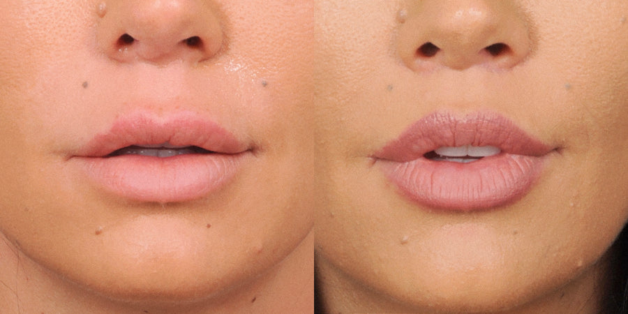 CUPID LIFT® | Deep Plane Upper Lip Lift | What is the CUPID LIFT ...